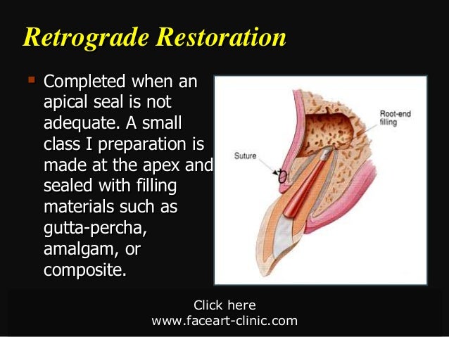 Root Canal Treatment for Patients & Dentist