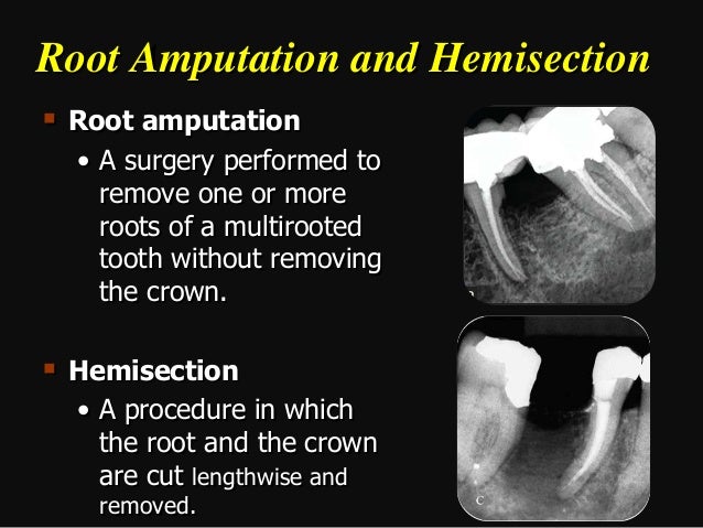 Root Canal Treatment for Patients & Dentist