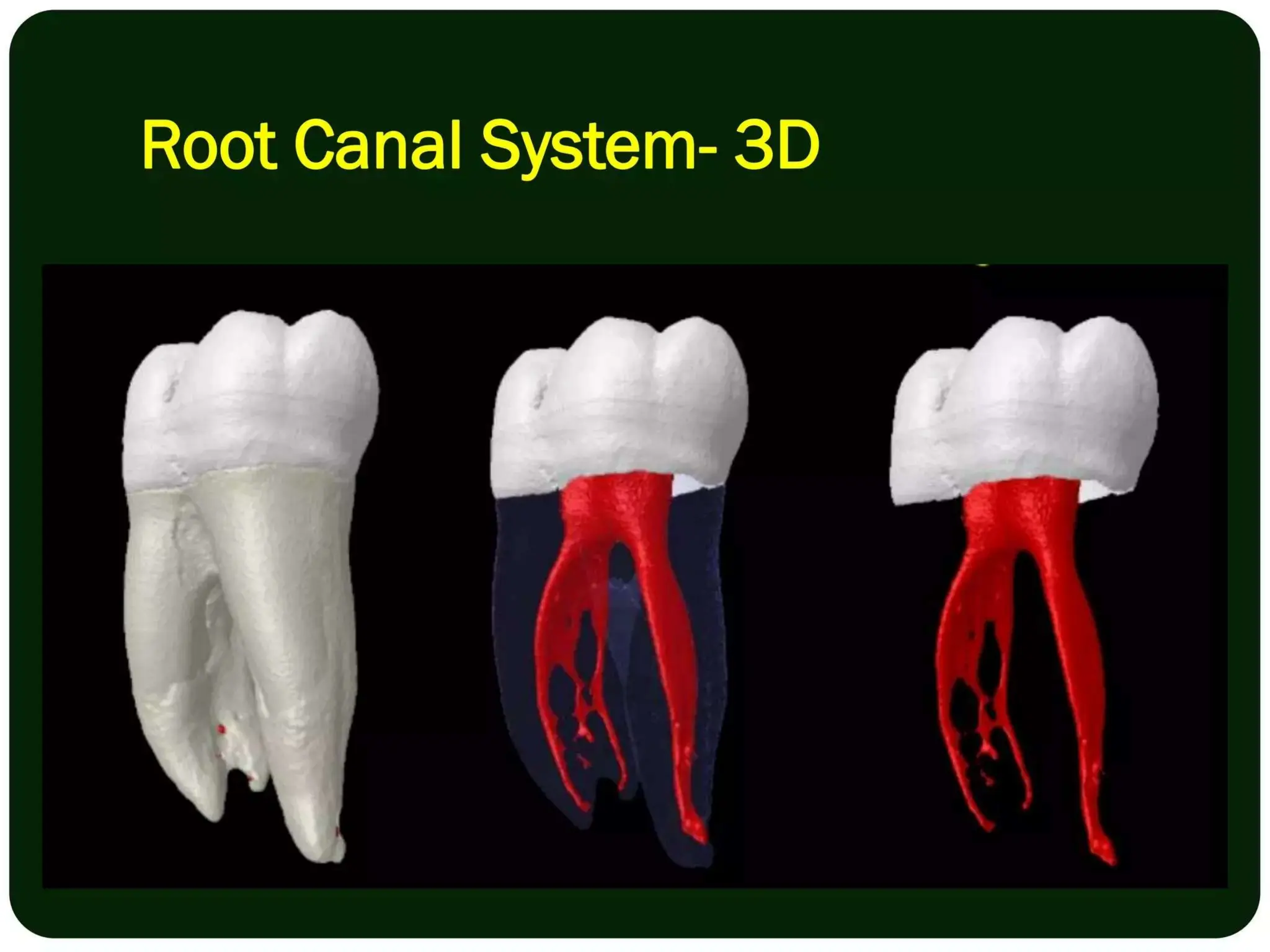 Root canal treatment acess cavity preparation | PPTX