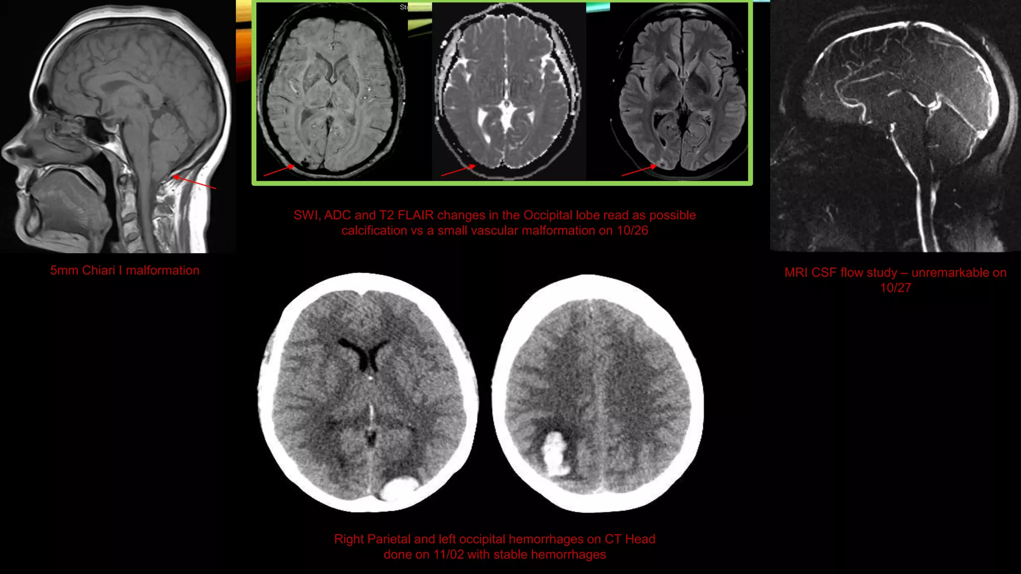 Reversible cerebral vasoconstriction syndrome | PPTX