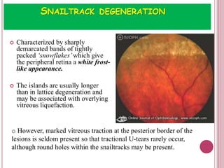 RETINAL DETACHMENT | PPT