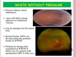 RETINAL DETACHMENT | PPT