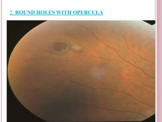 Operculated Retinal Hole