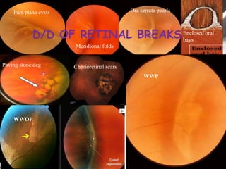 RETINAL DETACHMENT | PPT