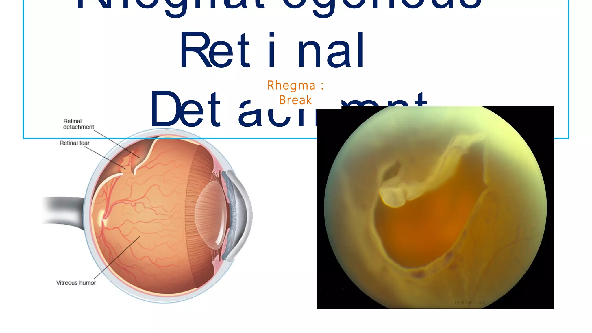 Retinal Detachment | Ophthalmology | PPT