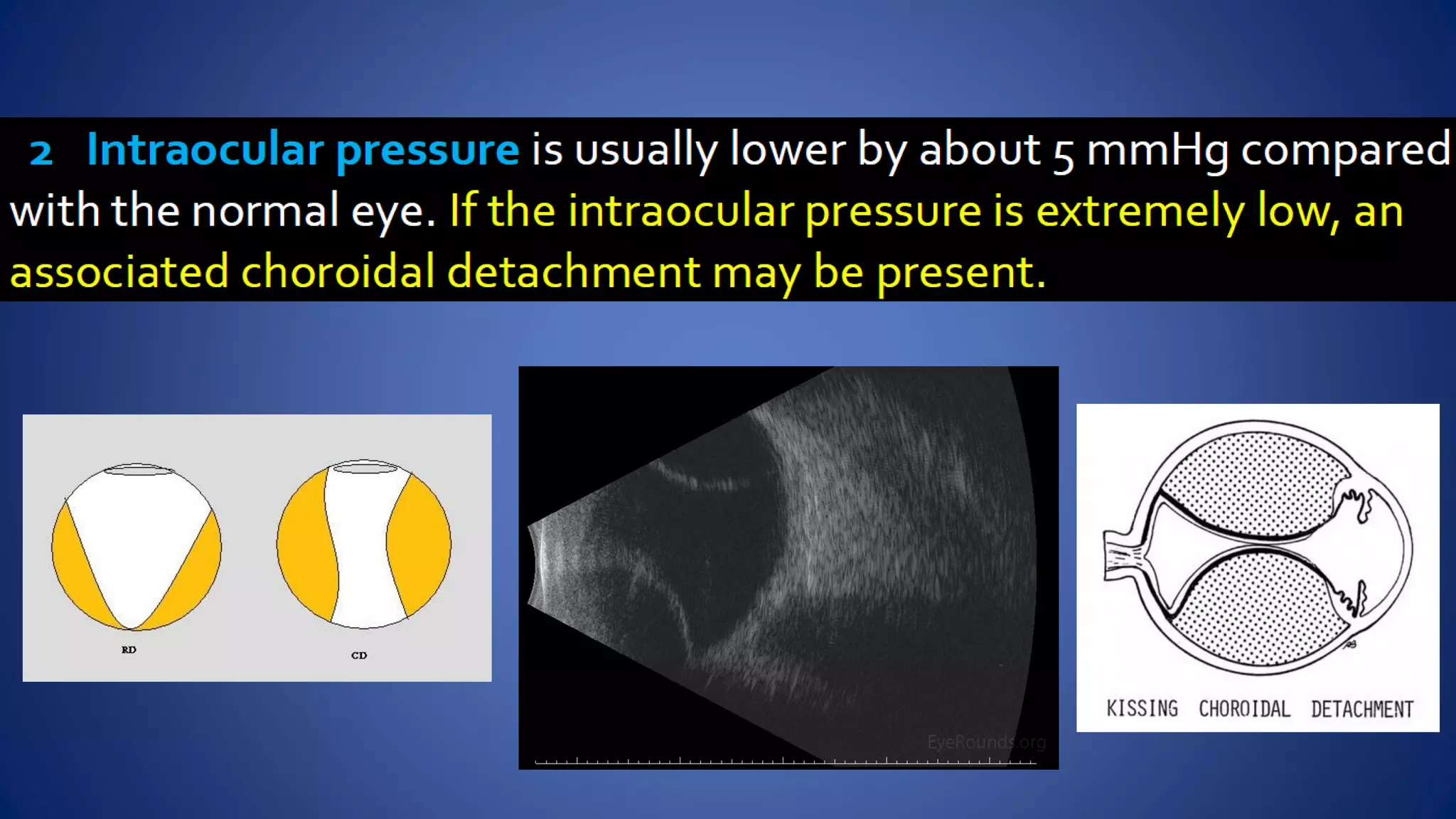 Retinal Detachment | Ophthalmology | PPT