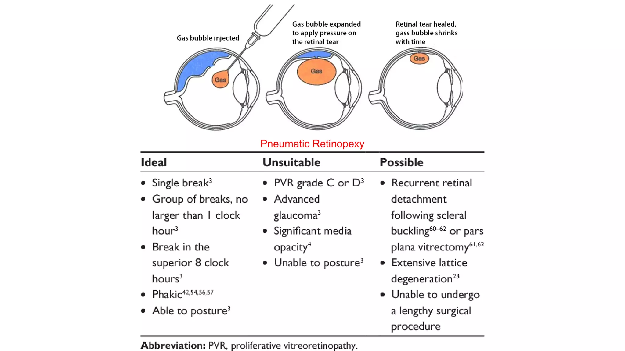 Retinal Detachment | Ophthalmology | PPT