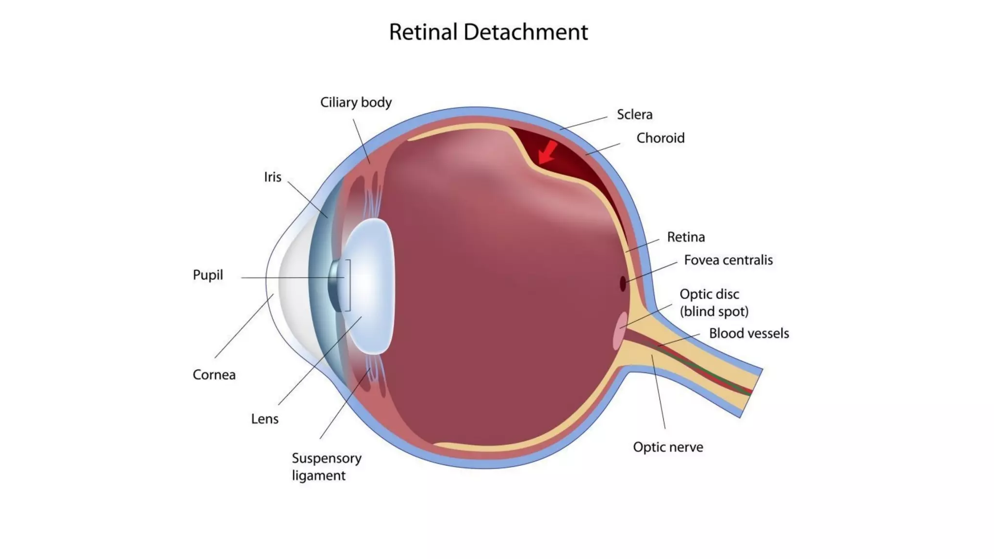 Retinal Detachment | Ophthalmology | PPT