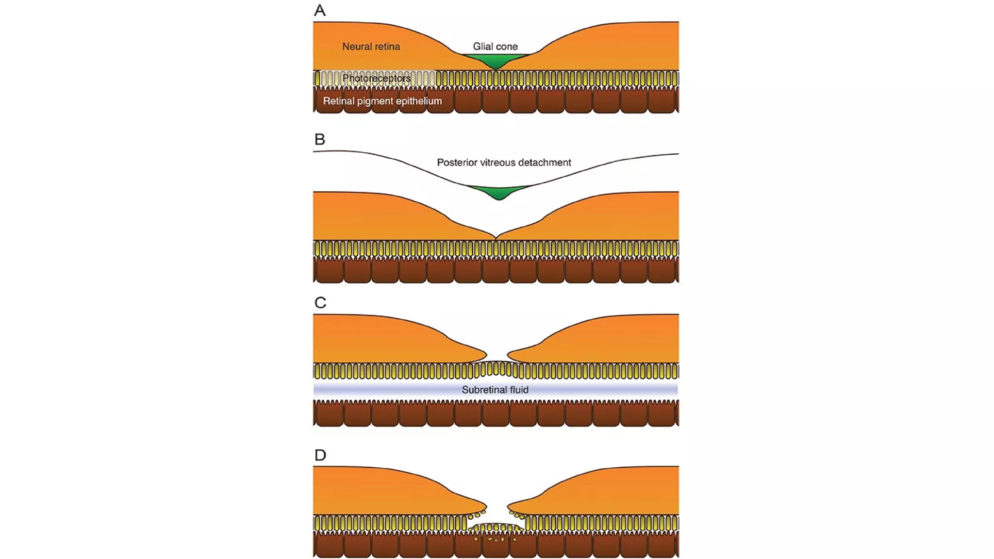 Retinal Detachment | Ophthalmology | PPT