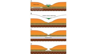 Retinal Detachment | Ophthalmology | PPT