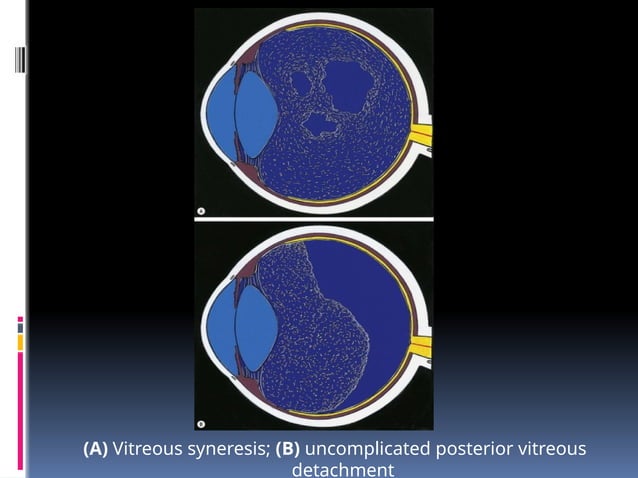 retinal detachment evaluation and management | PPTX