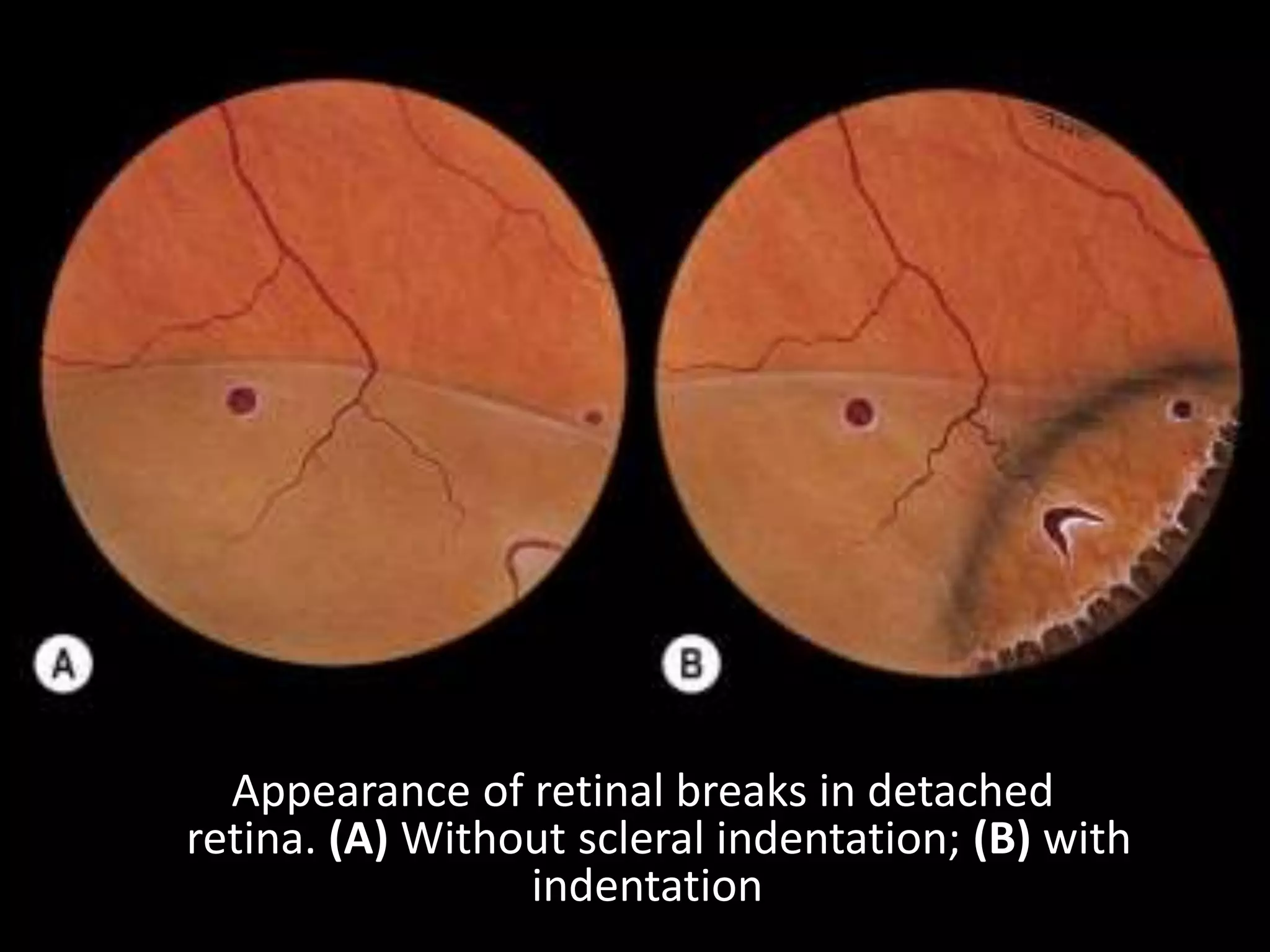 Retinal detachment | PPTX