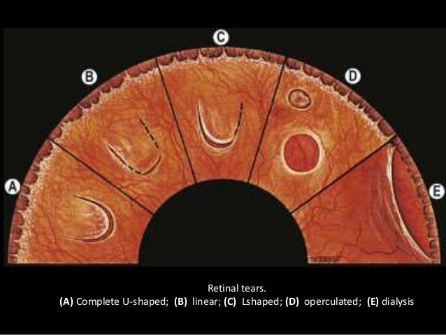 Operculated Retinal Hole In Retinal Detachment Retina