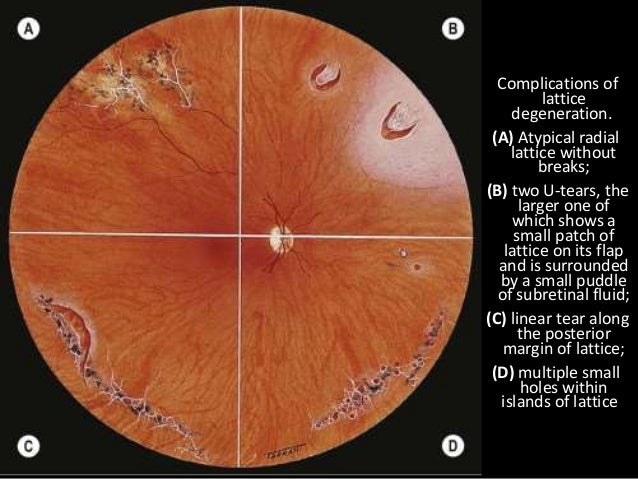 Retinal detachment