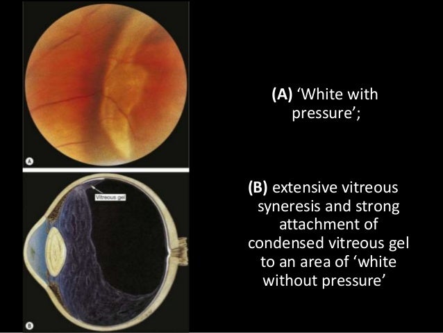 Retinal detachment