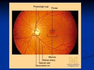 Retinal Detachment for medical students | PPT
