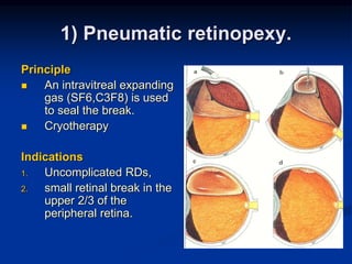Retinal Detachment for medical students | PPT
