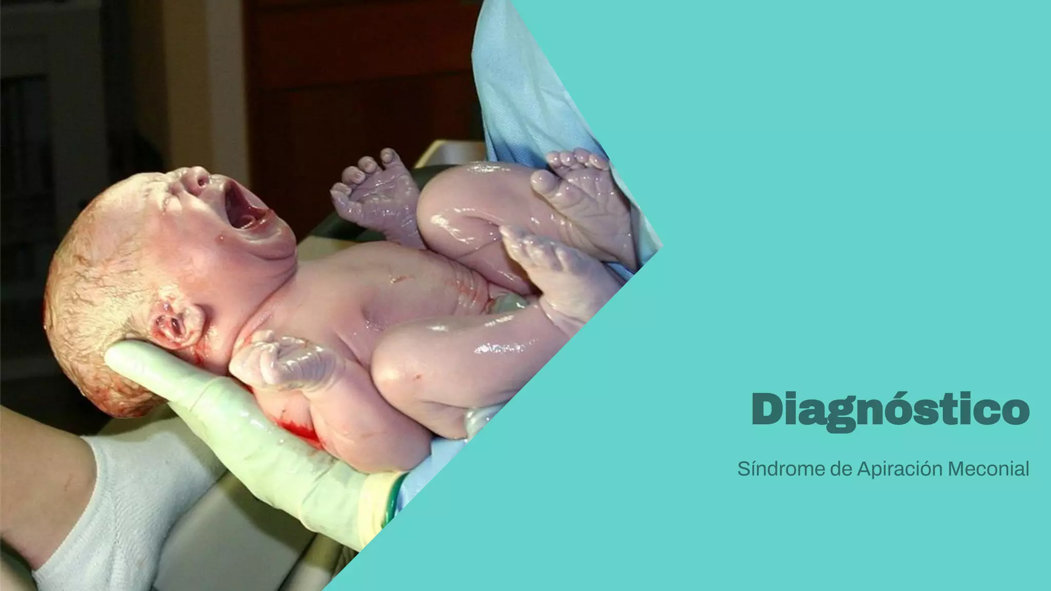 SÍNDROME DE ASPIRACIÓN MECONIAL Y ATELECTASIA | PDF | Pregnancy ...