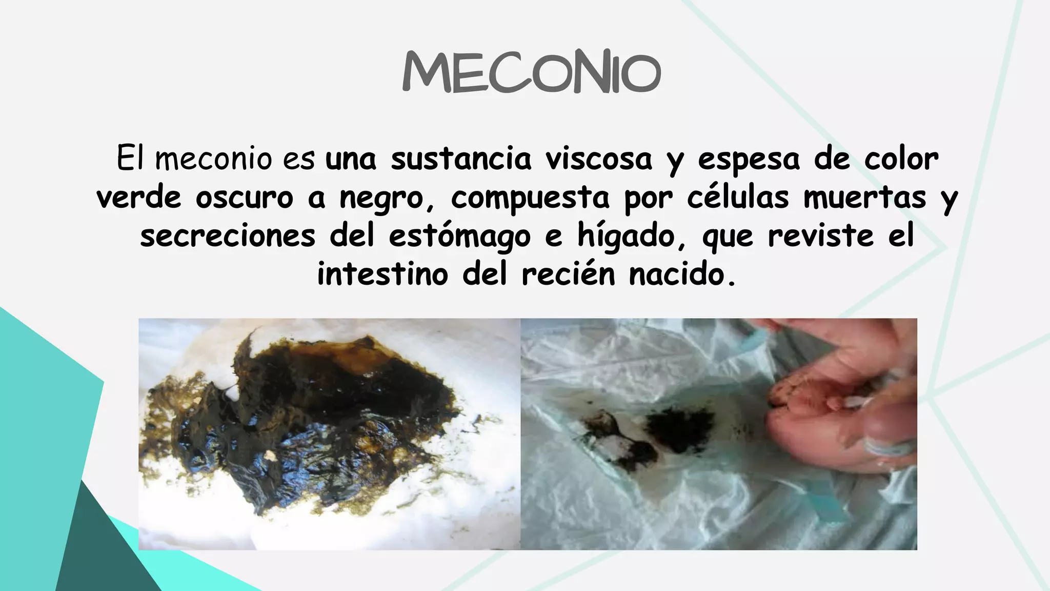 SÍNDROME DE ASPIRACIÓN MECONIAL Y ATELECTASIA | PDF | Pregnancy ...