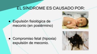 SÍNDROME DE ASPIRACIÓN MECONIAL Y ATELECTASIA | PDF
