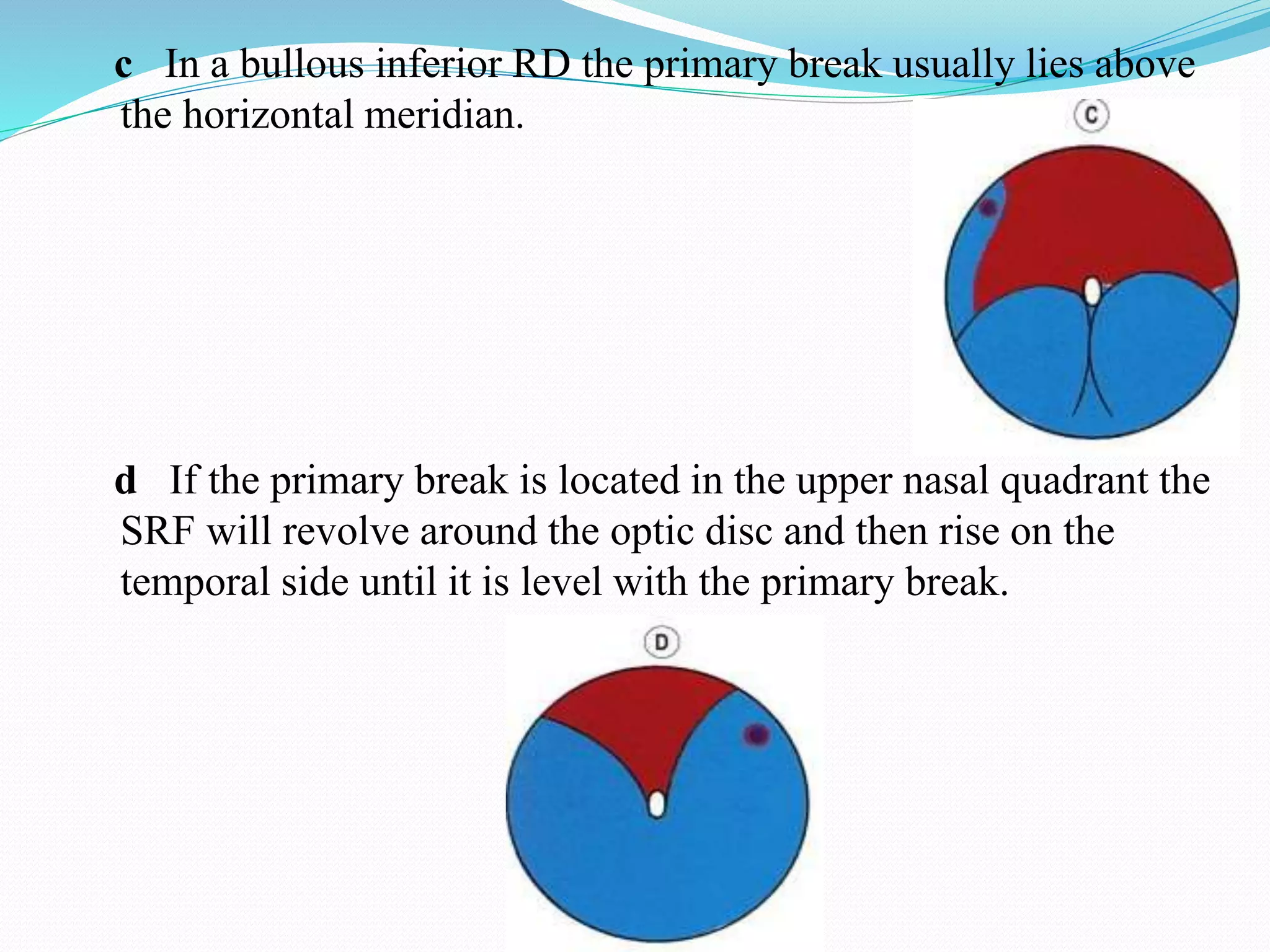 RETINAL DETACHMENT | PPTX