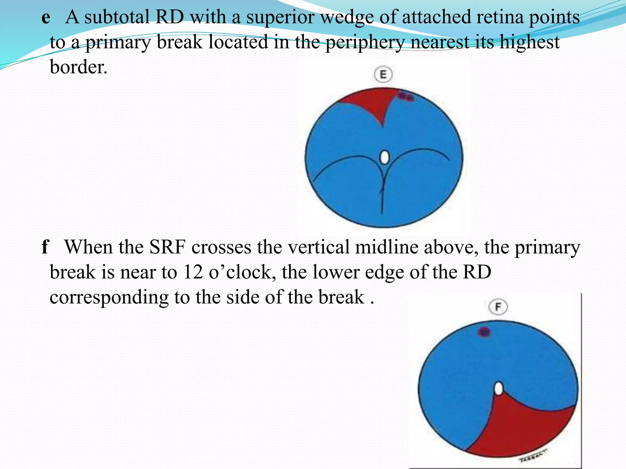 RETINAL DETACHMENT | PPTX