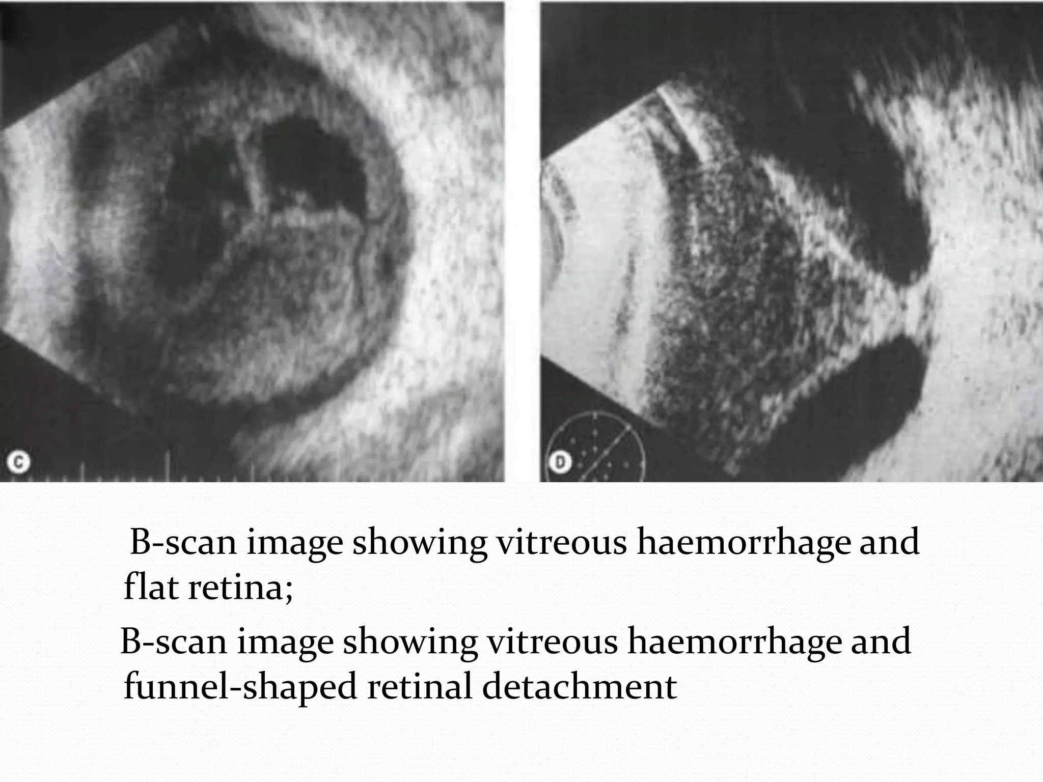 RETINAL DETACHMENT | PPTX
