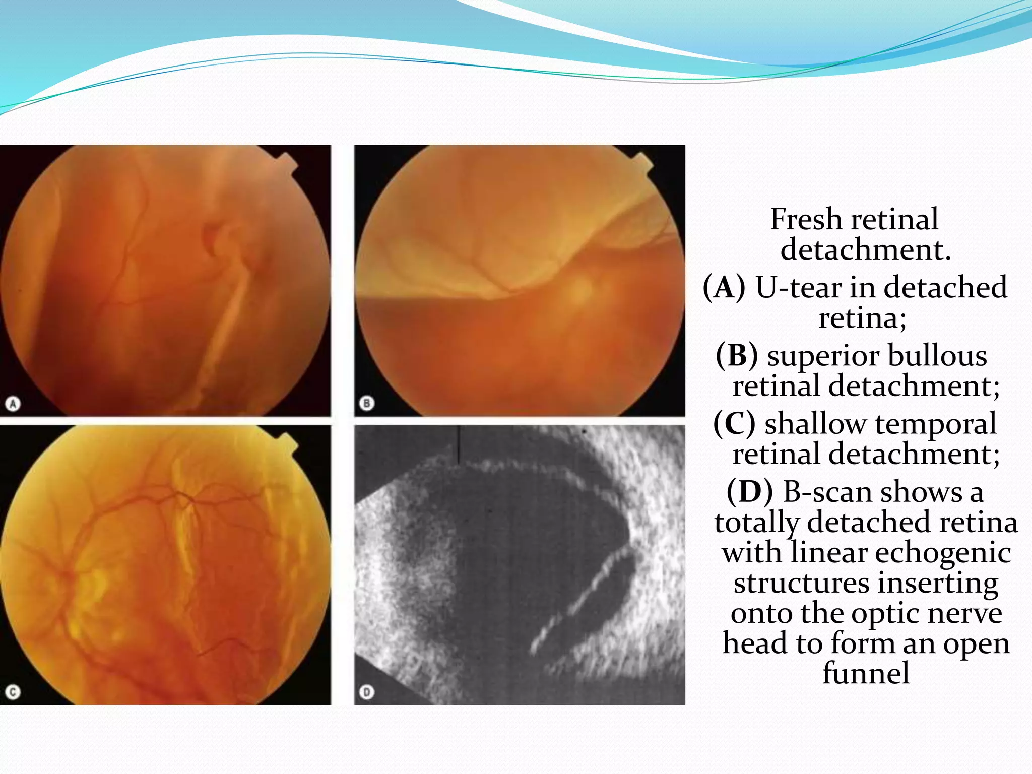 RETINAL DETACHMENT | PPTX