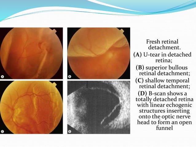 RETINAL DETACHMENT | PPTX