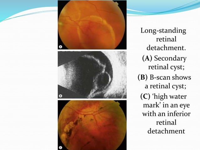 RETINAL DETACHMENT | PPTX