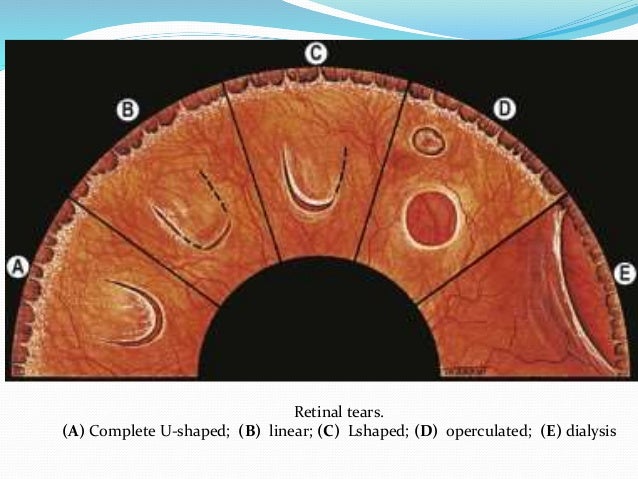 RETINAL DETACHMENT