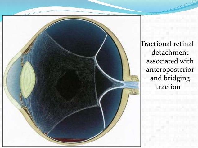 RETINAL DETACHMENT