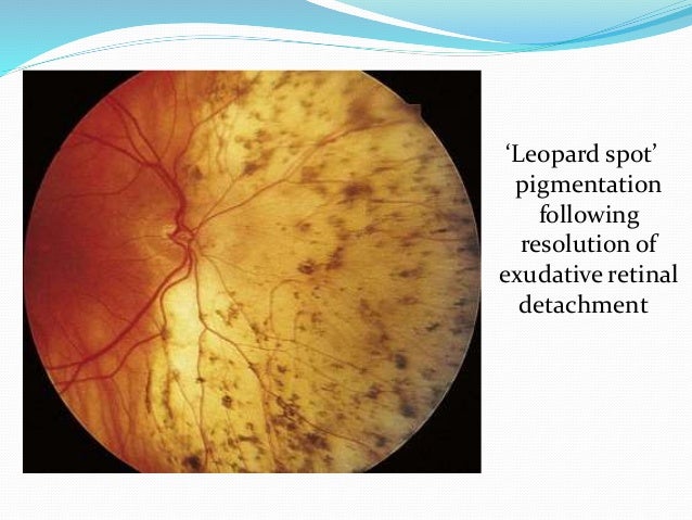 RETINAL DETACHMENT