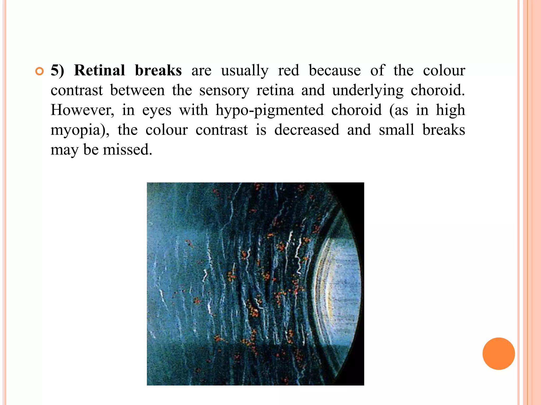 Retinal detachment presentation | PPTX