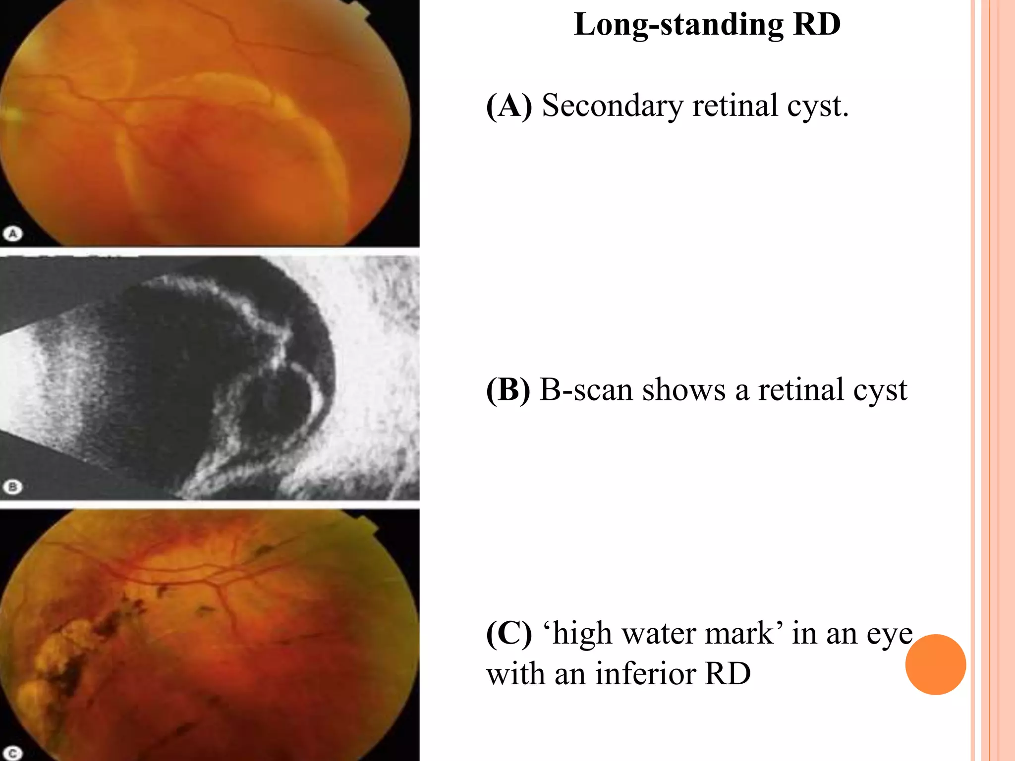 Retinal detachment presentation | PPTX