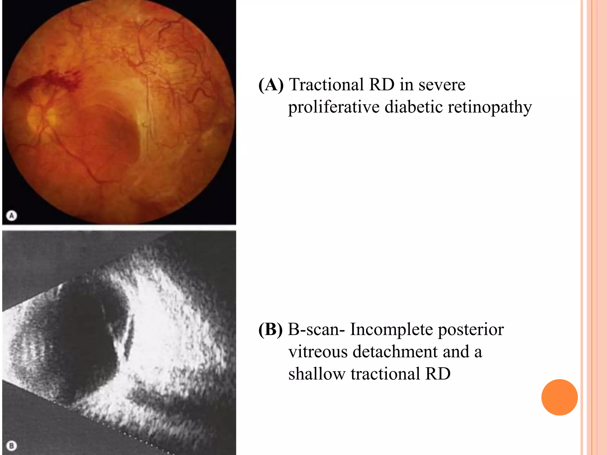 Retinal detachment presentation | PPTX