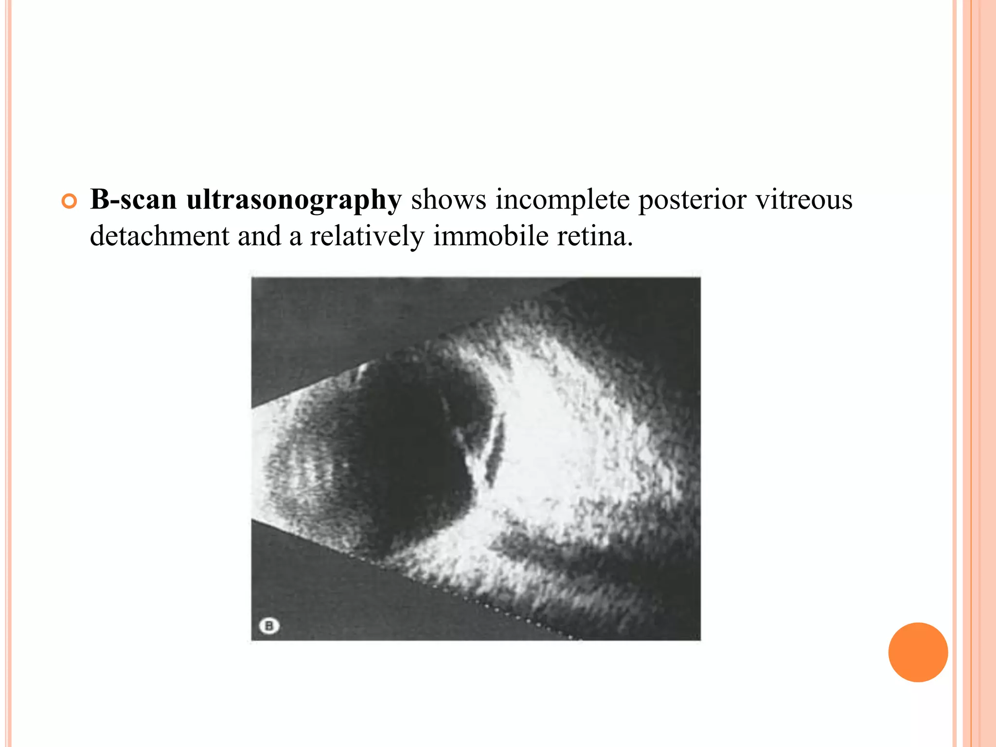 Retinal detachment presentation | PPTX