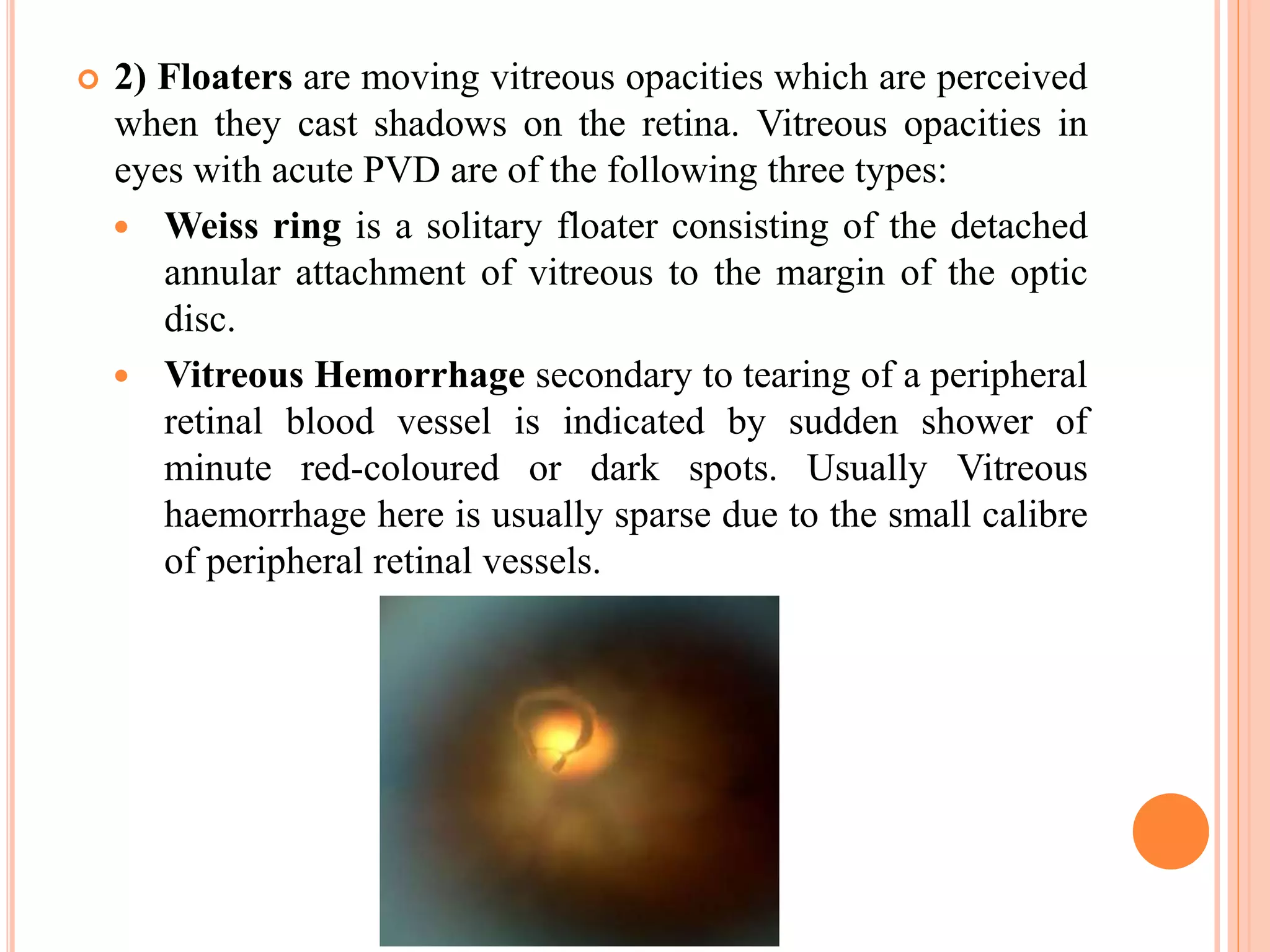 Retinal detachment presentation | PPTX