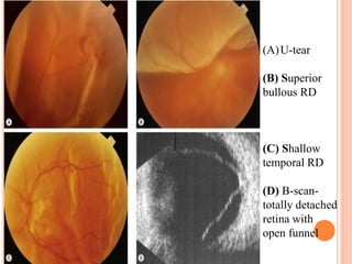Retinal detachment presentation | PPTX