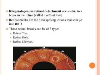 Retinal detachment presentation | PPTX