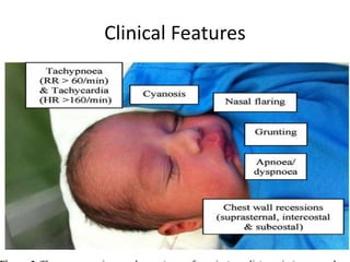 RDS IN NEONATES.pptx