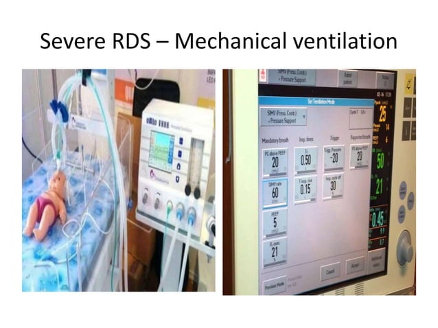 RDS IN NEONATES.pptx