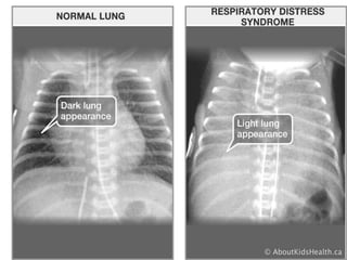 RDS IN NEONATES.pptx