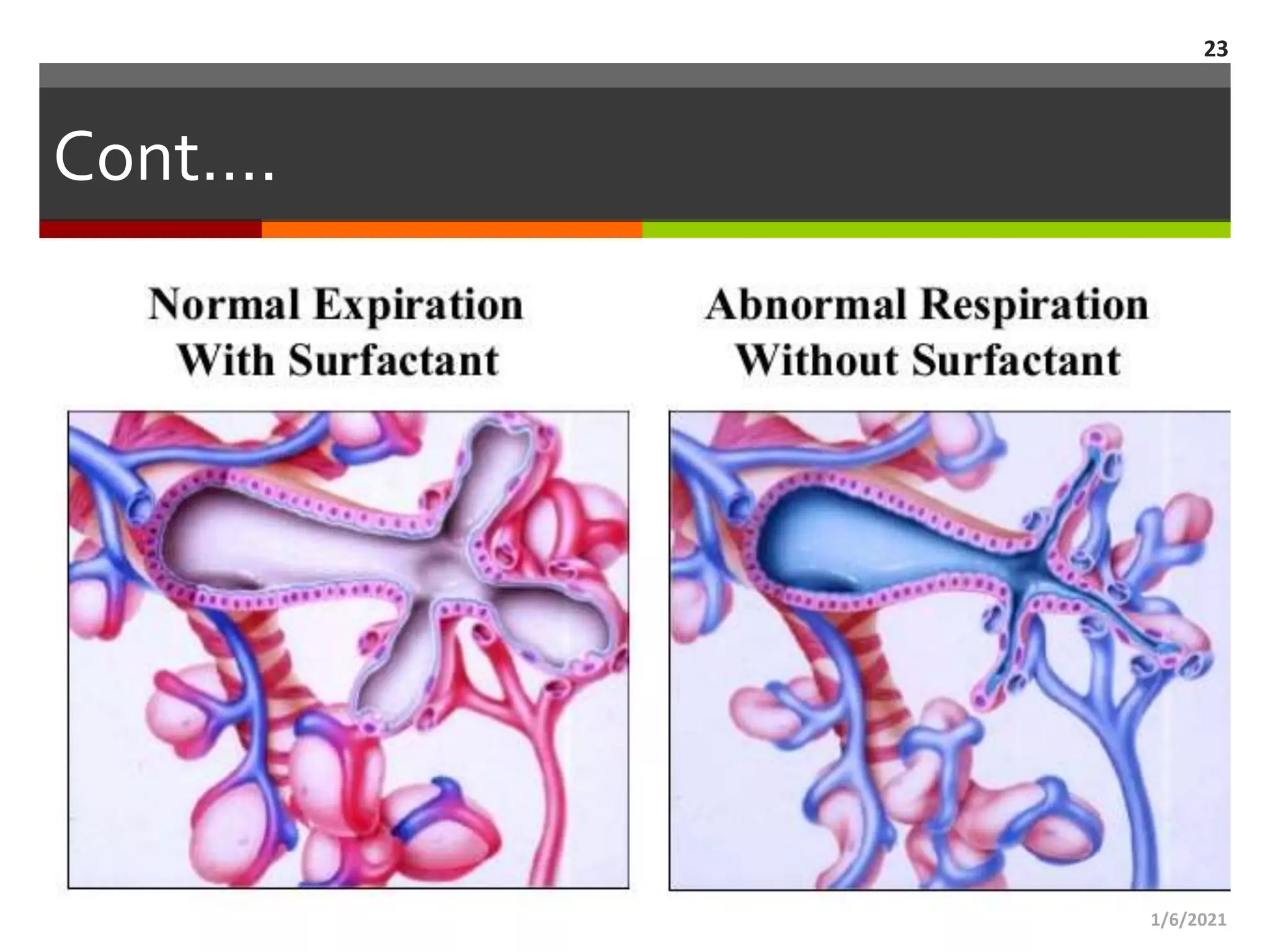 RDS (neonate respiratory distress syndrome) | PPTX