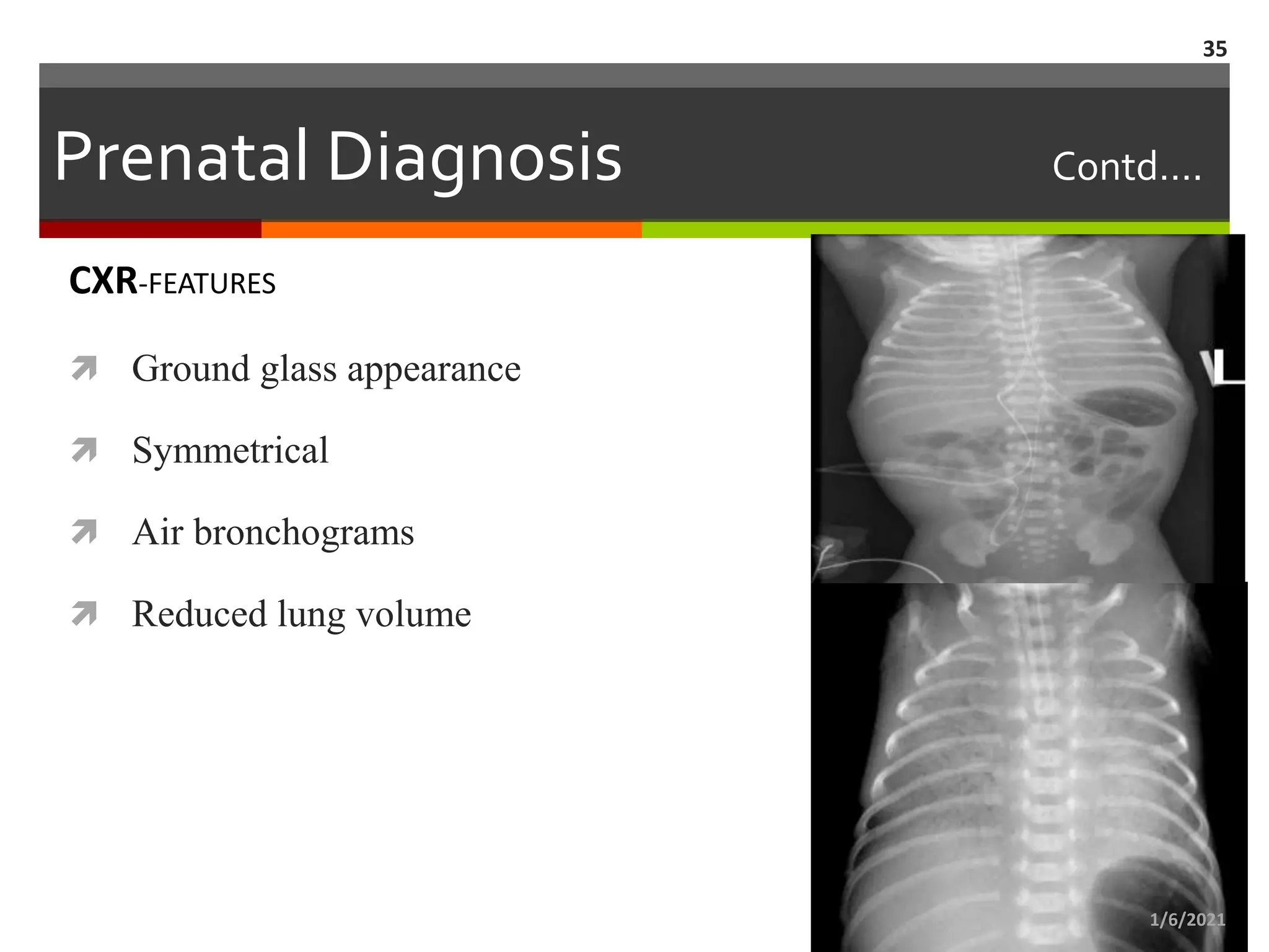RDS (neonate respiratory distress syndrome) | PPTX