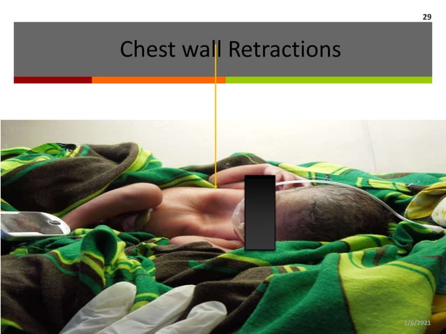RDS (neonate respiratory distress syndrome) | PPTX