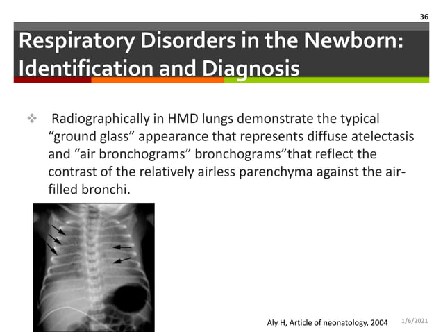 RDS (neonate respiratory distress syndrome) | PPTX