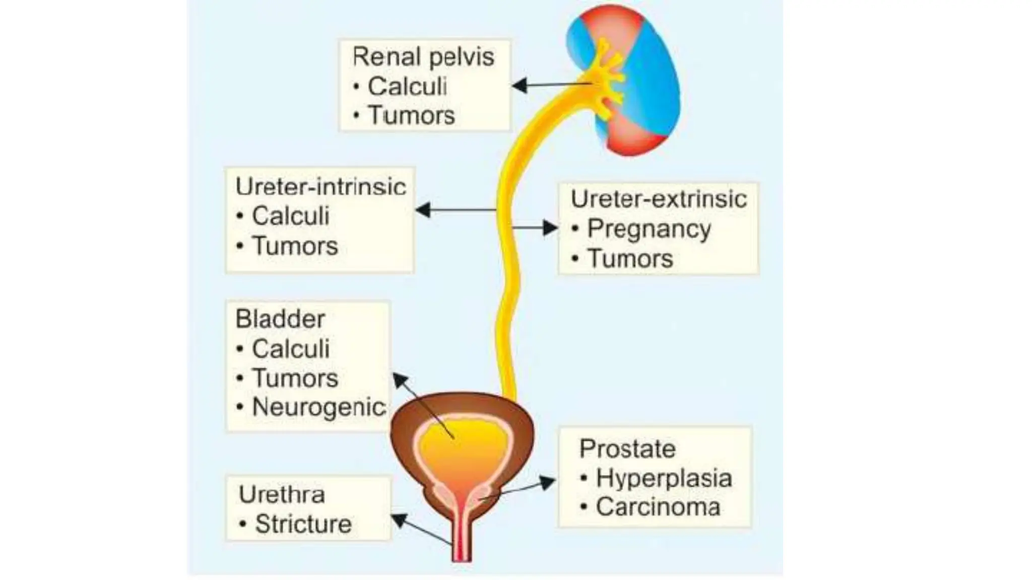 Hydronephrosis - Pathology - Allied Health Sciences | PPTX