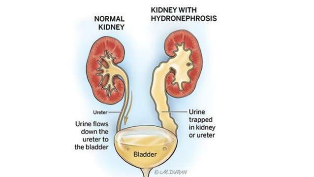 Hydronephrosis - Pathology - Allied Health Sciences | PPTX