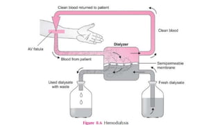 Renal replacement therapies(RRT) - Medicine - RDT | PPTX